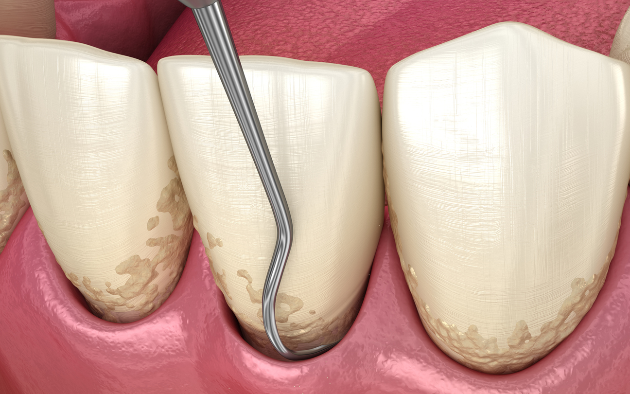Periodontal Deep Cleaning: Know the Before, During, and After